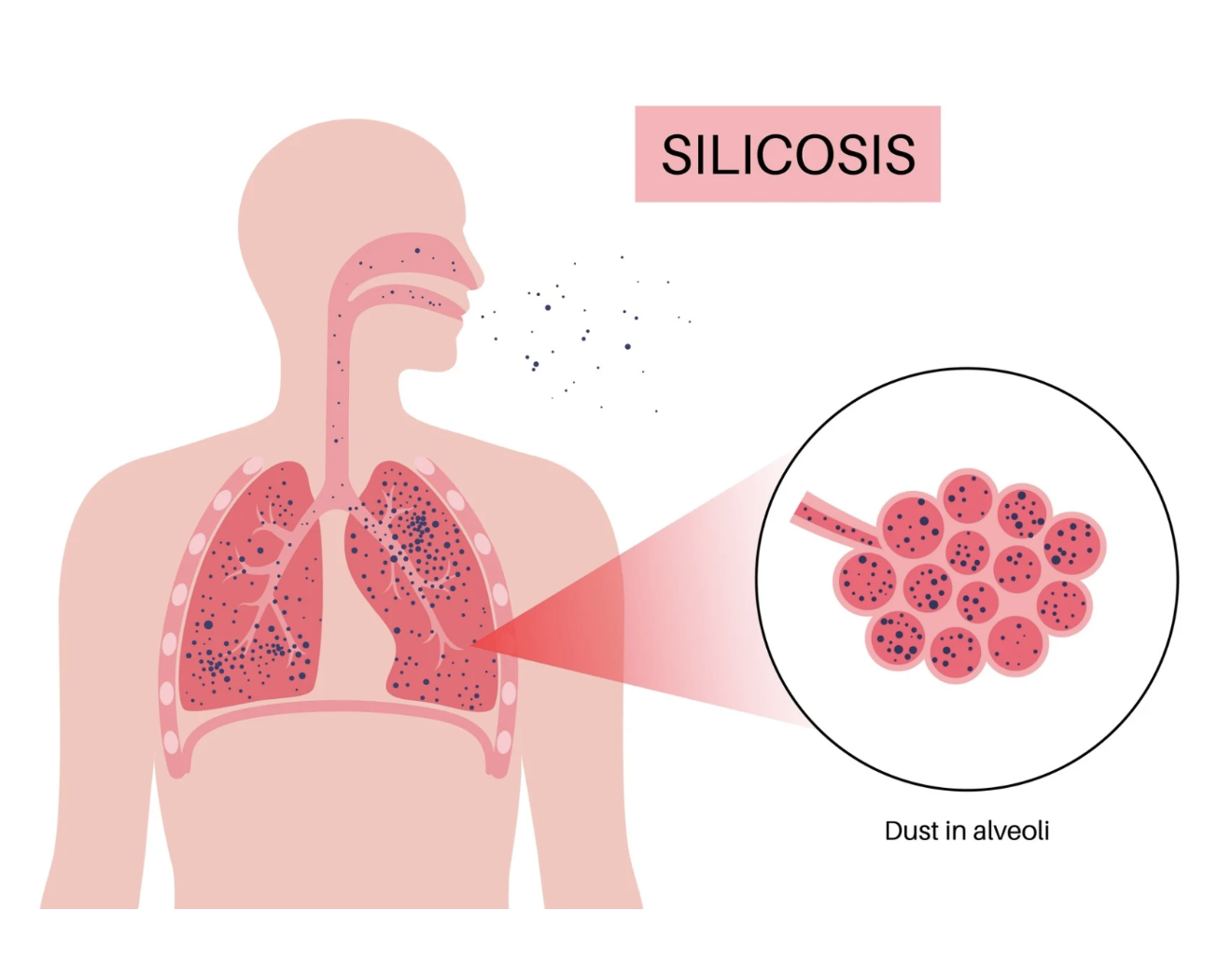Silicosis research and Engineered stone - GARDS
